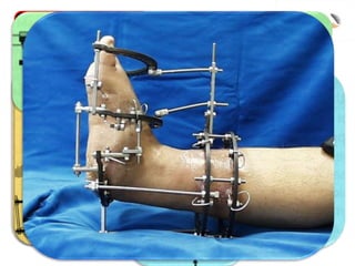 Lecture 37 shah ttc fusion | PPTX