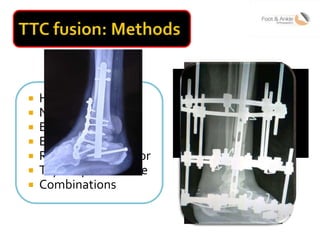 Lecture 37 shah ttc fusion | PPTX