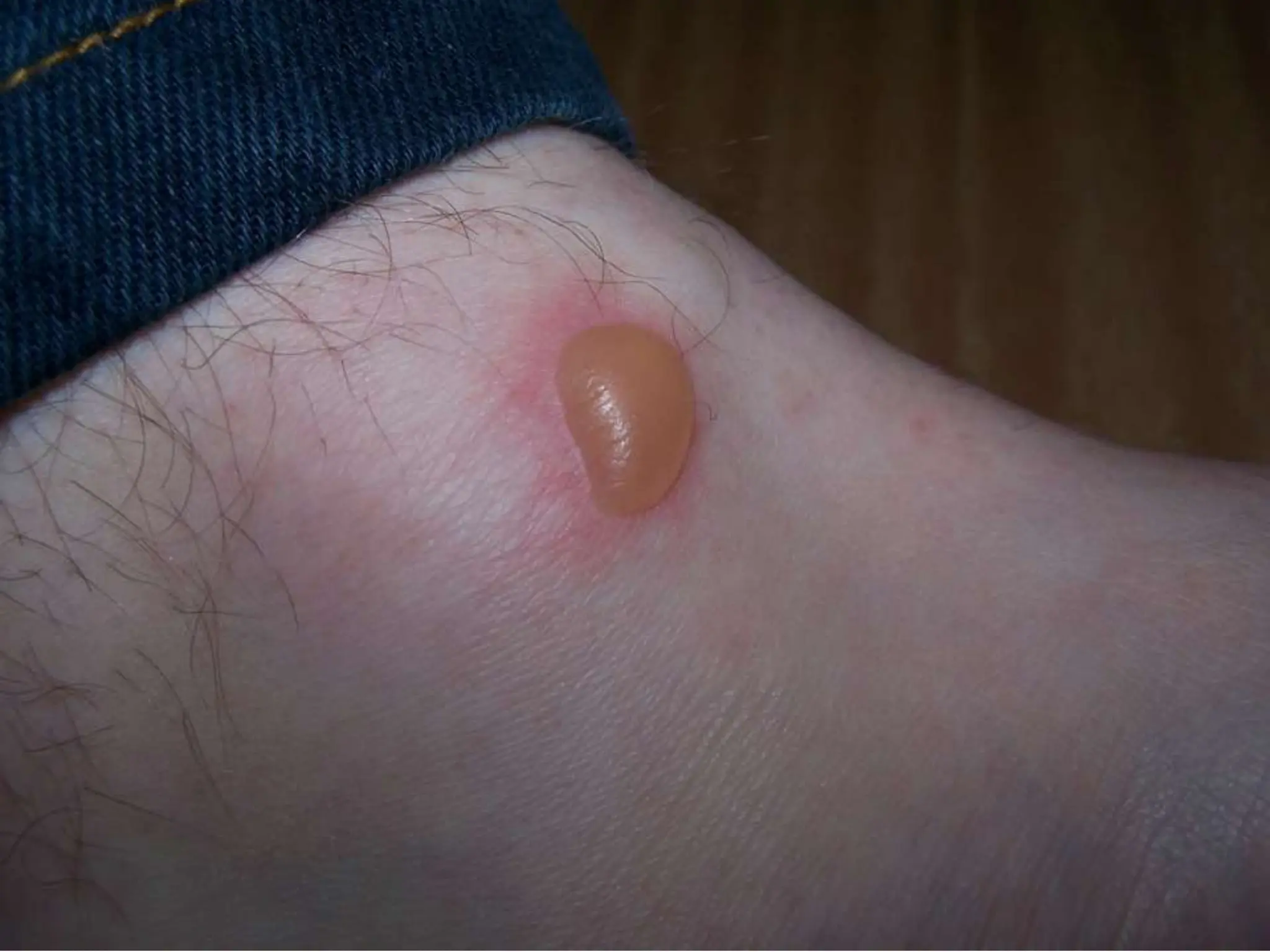 Lecture 3 Acute inflammation definition, events, signs and ...