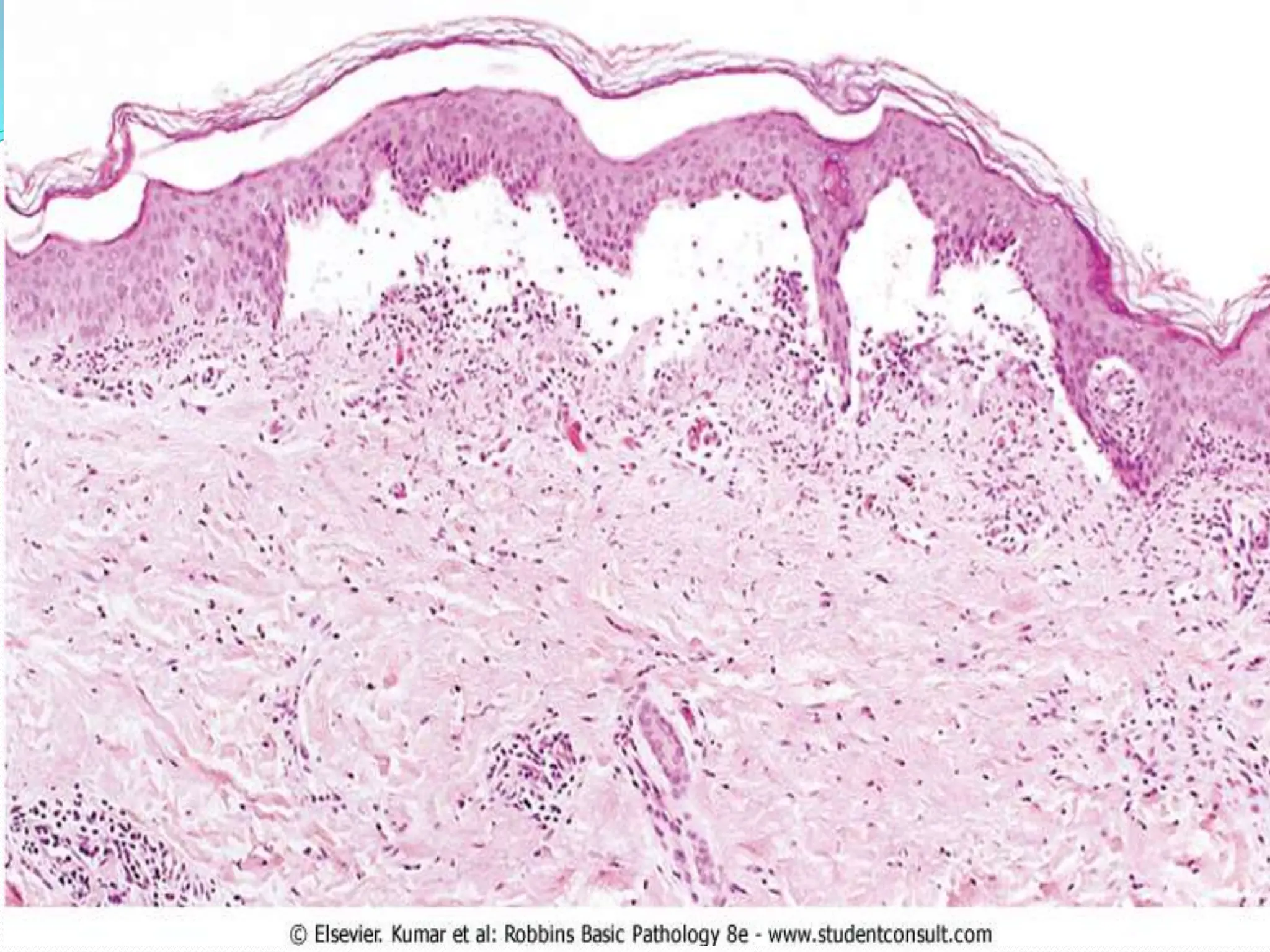 Lecture 3 Acute inflammation definition, events, signs and ...