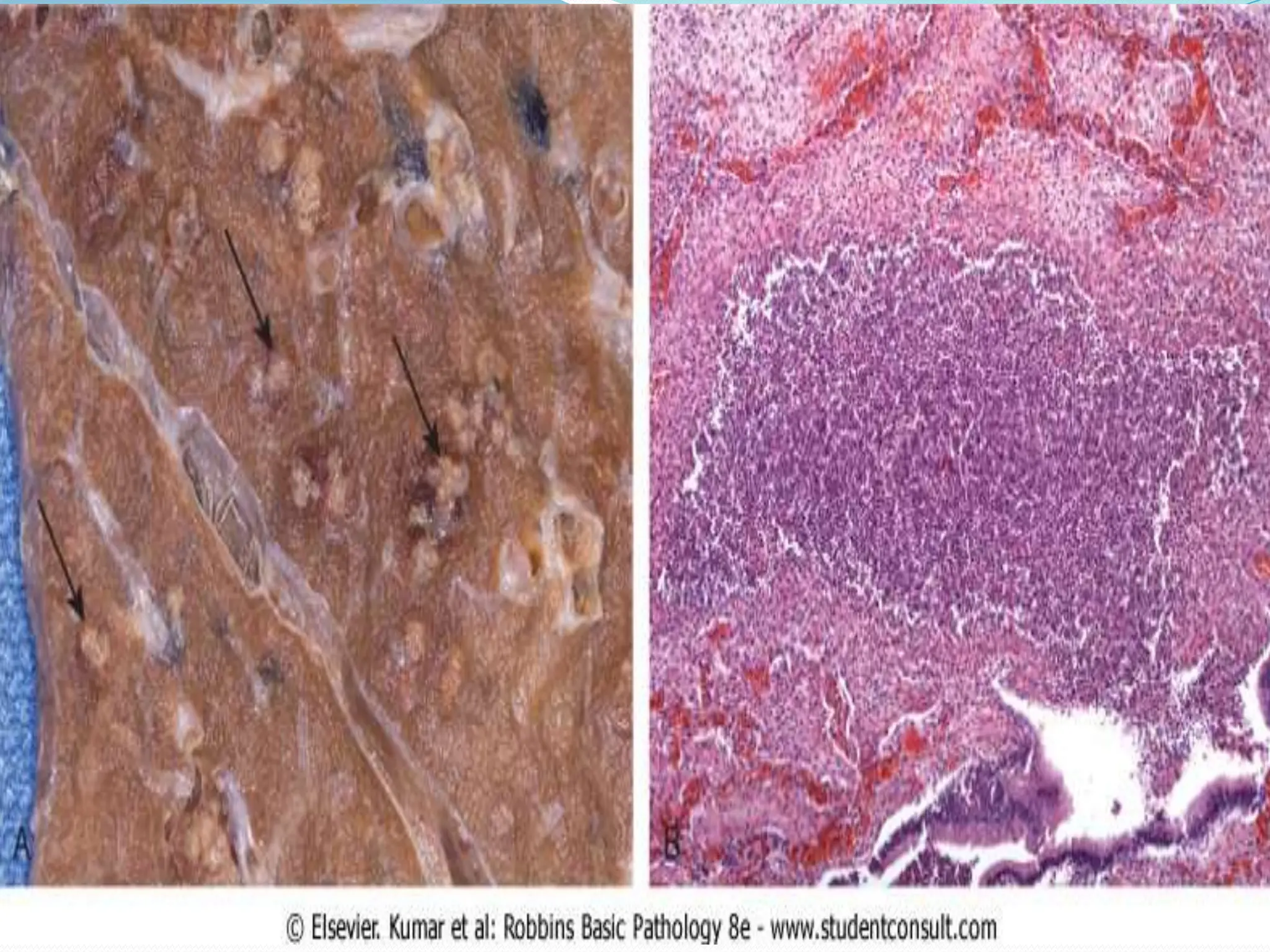 Lecture 3 Acute inflammation definition, events, signs and ...