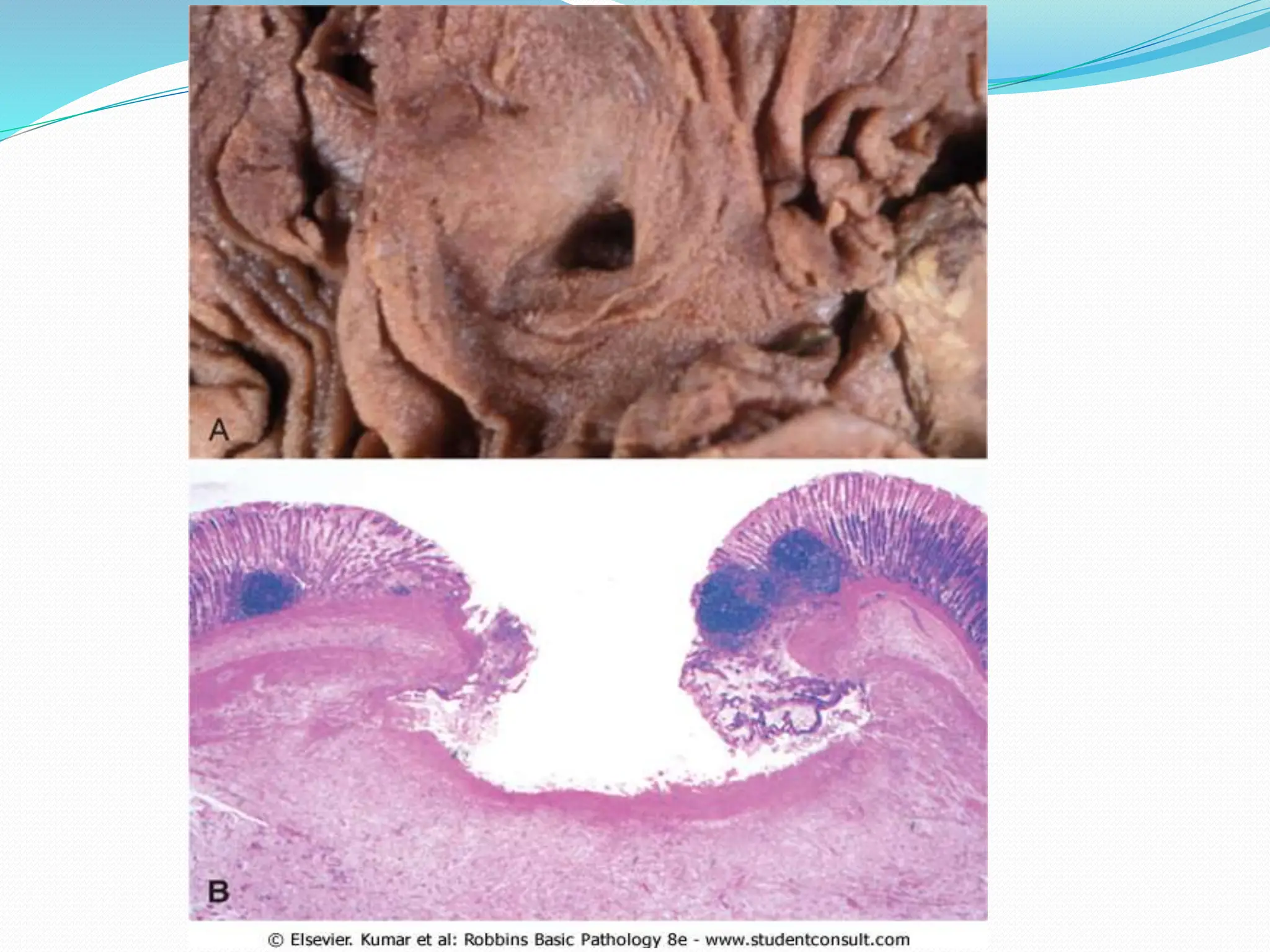 Lecture 3 Acute inflammation definition, events, signs and ...