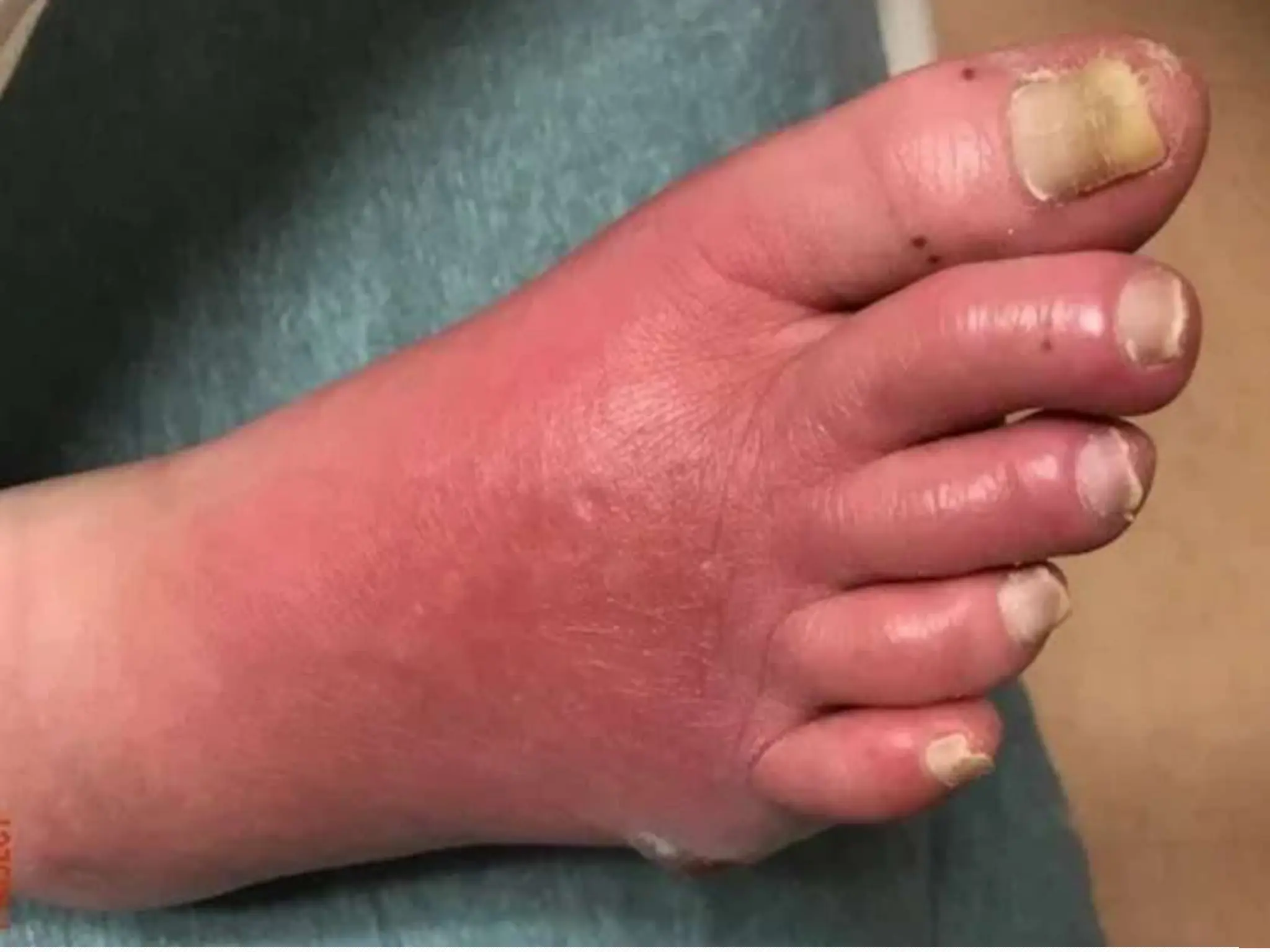 Lecture 3 Acute inflammation definition, events, signs and ...