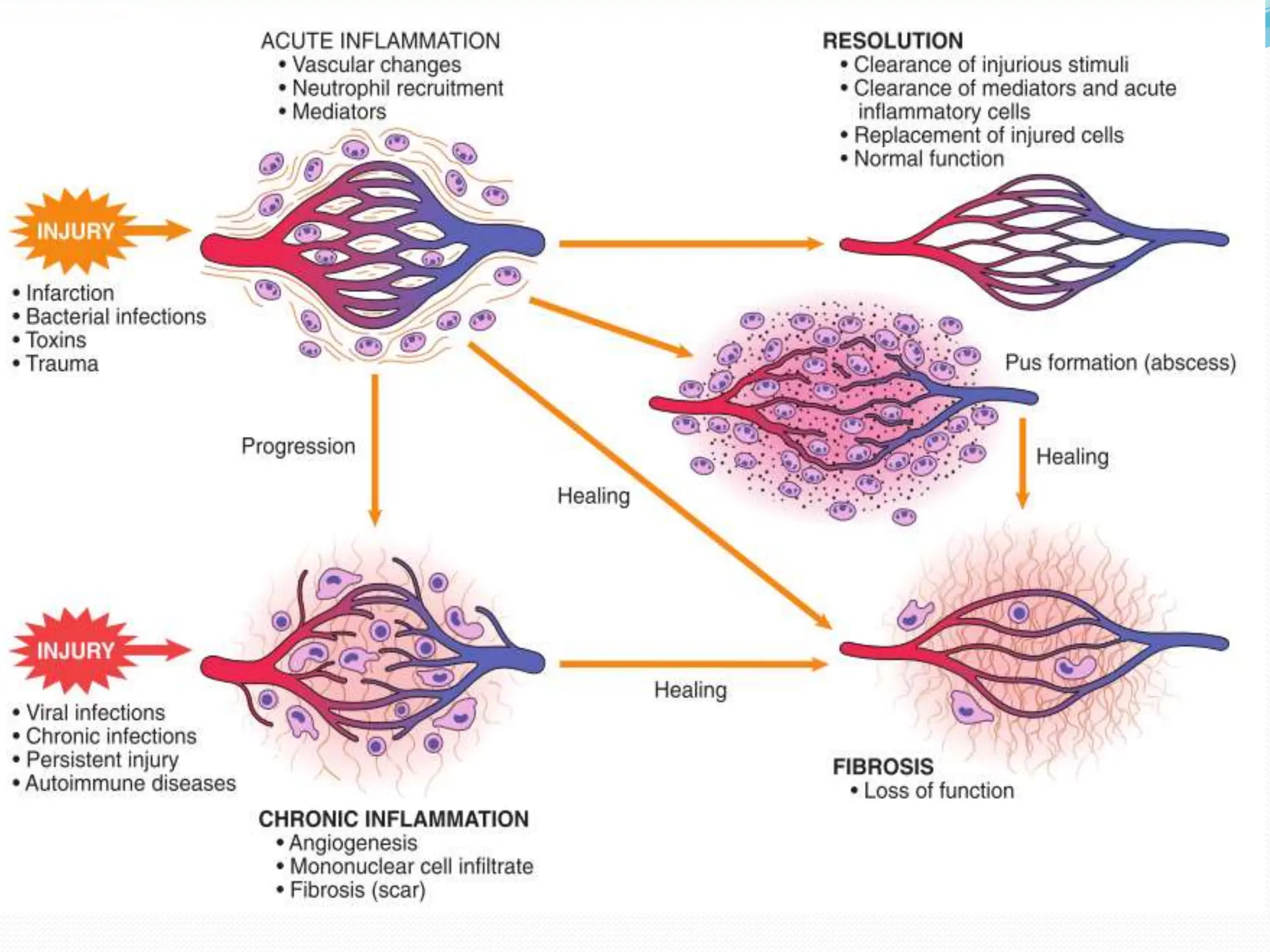 Lecture 3 Acute inflammation definition, events, signs and ...