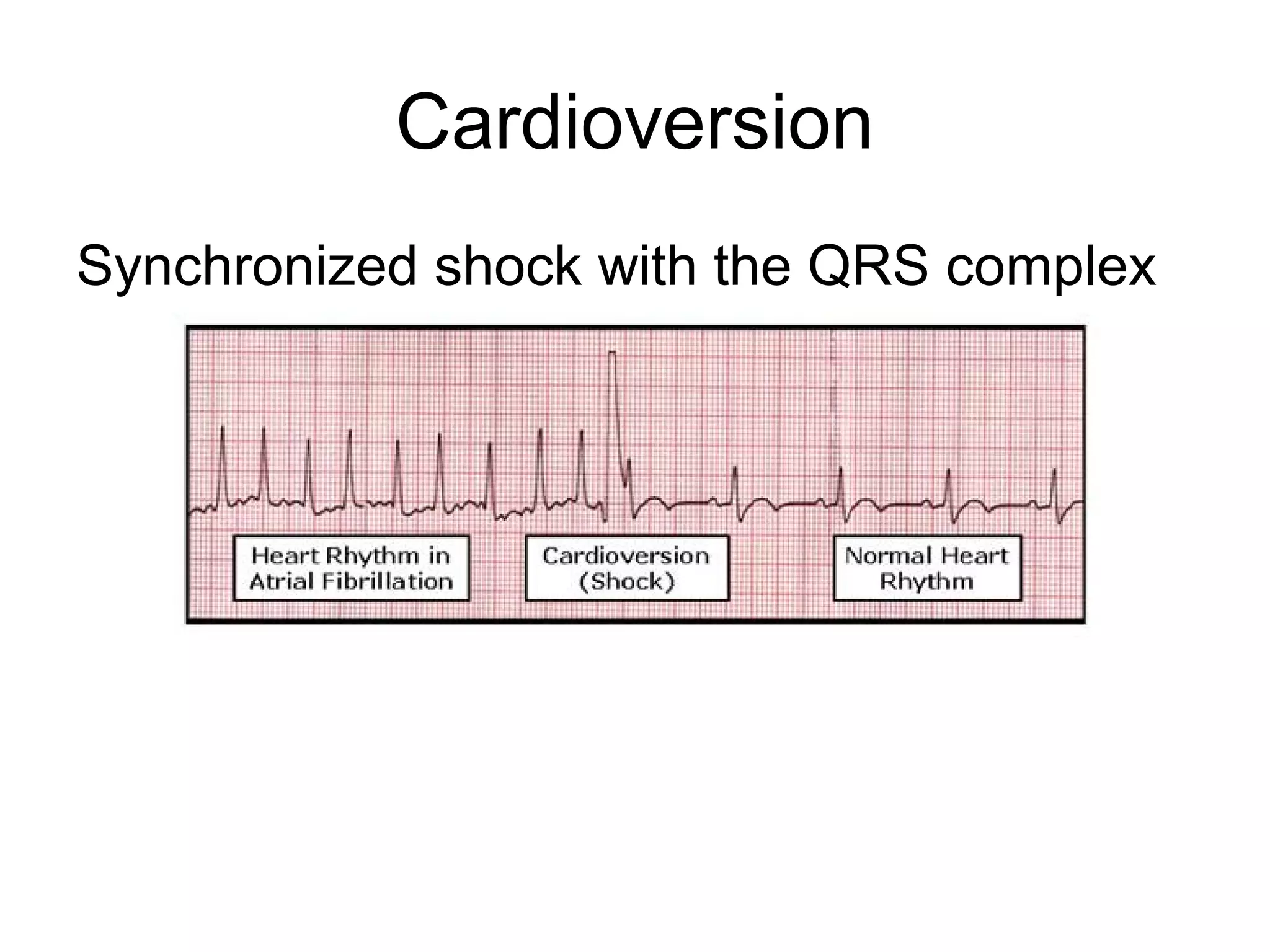 Lecture 3 cardiac rhythms | PPT