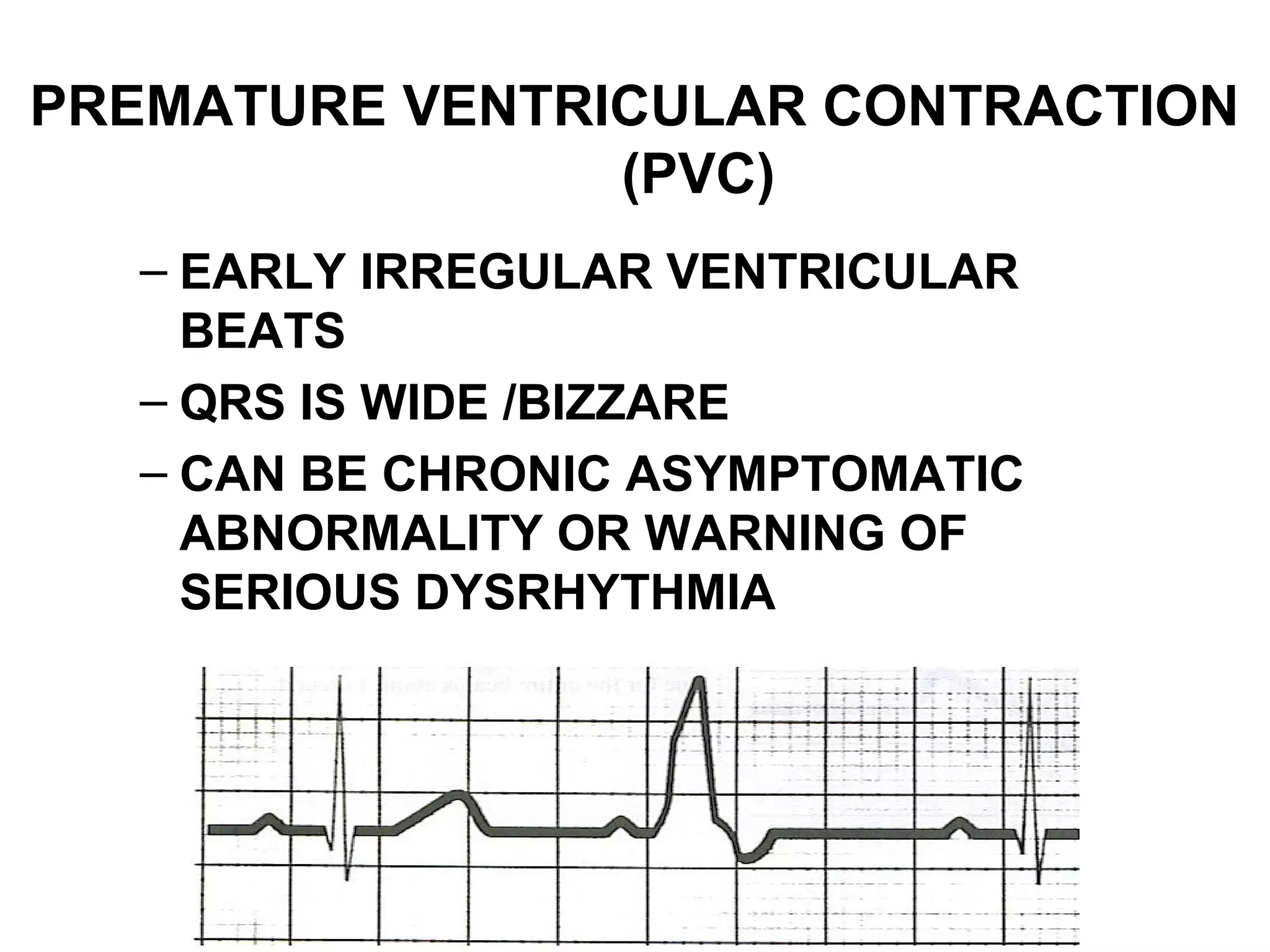 Lecture 3 cardiac rhythms | PPT