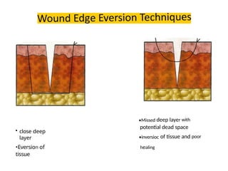 Lecture 3 Lacerations and suture technique.pptx