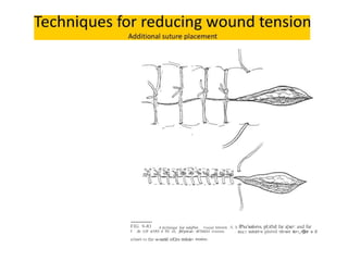 Lecture 3 Lacerations and suture technique.pptx
