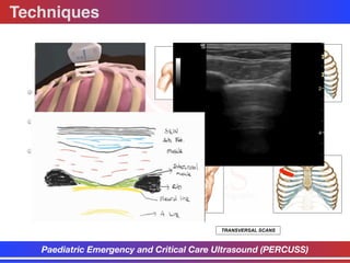 Paediatric Emergency and Critical Care Ultrasound - Lung Ultrasound | PDF