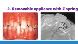 Lecture 3 managment of the developing dentition | PPTX