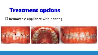 Lecture 3 managment of the developing dentition | PPT