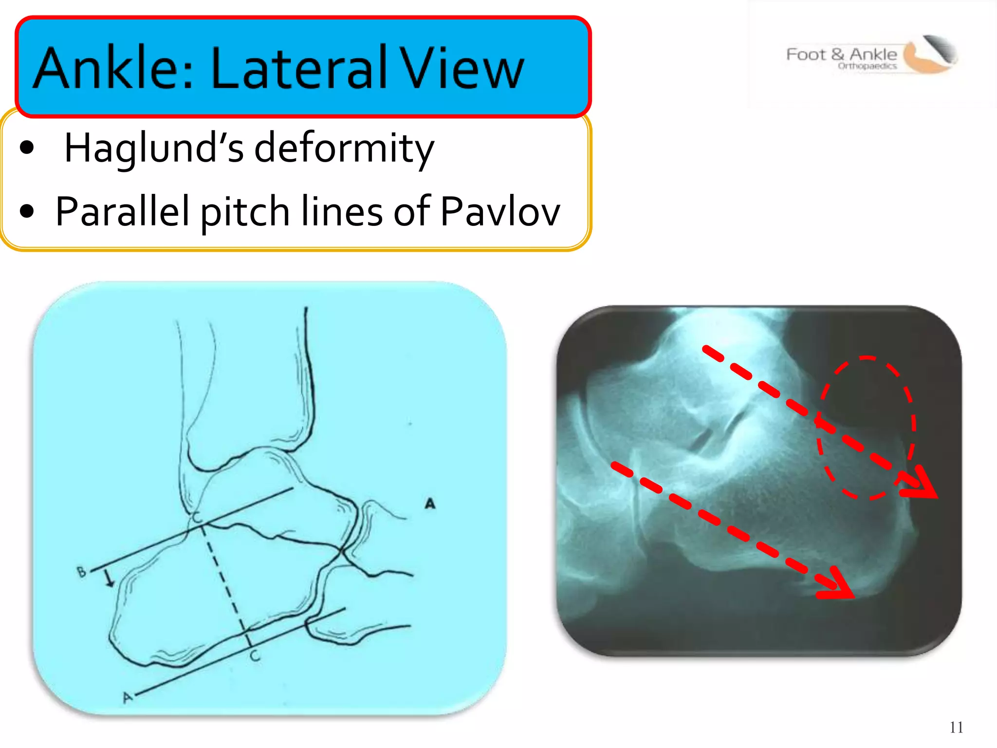 Lecture 3 shah radiology in foot and ankle | PPTX