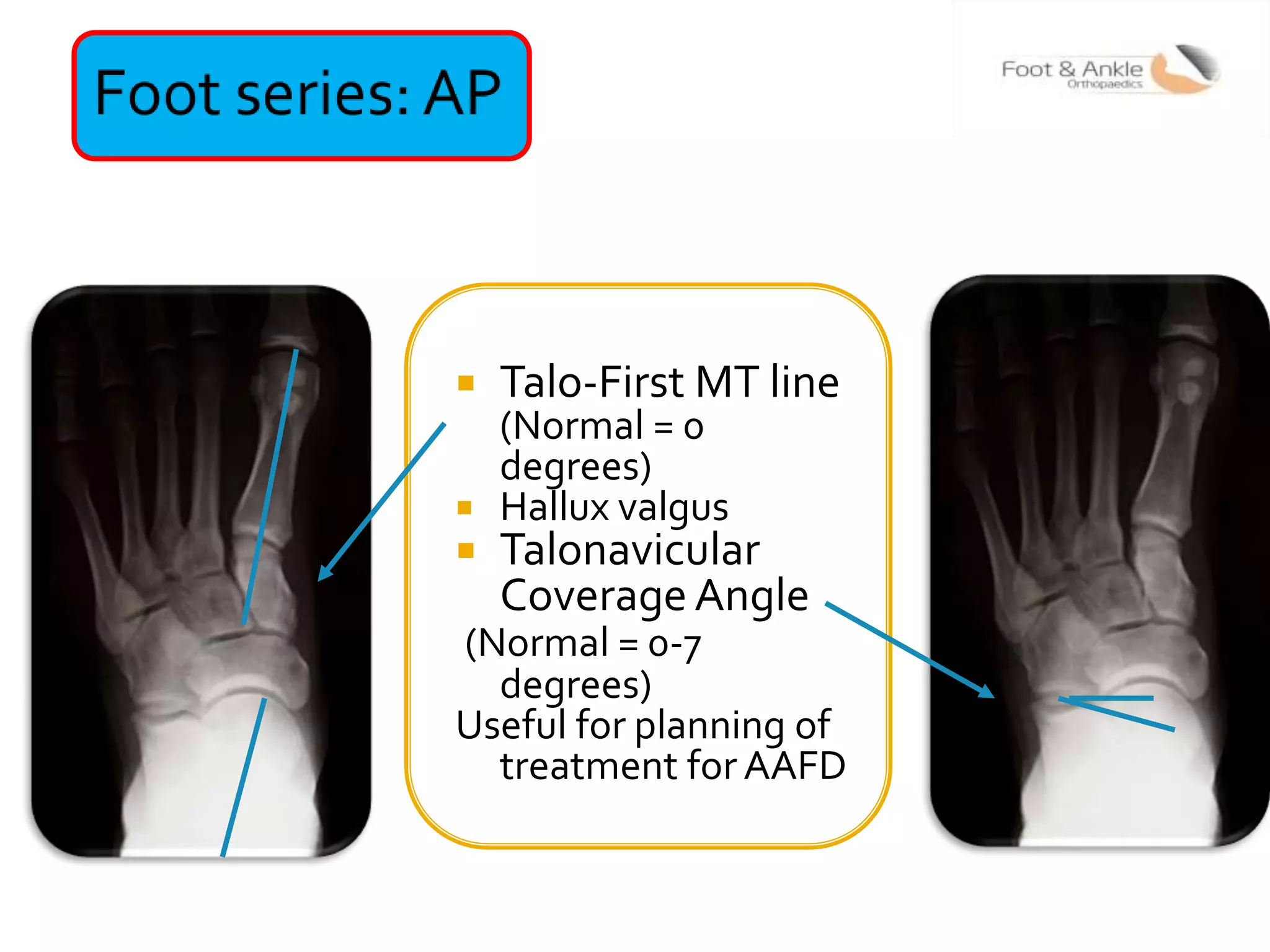 Lecture 3 shah radiology in foot and ankle | PPTX