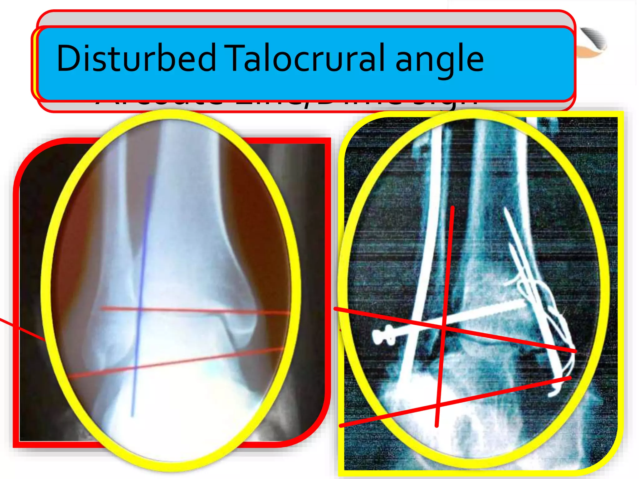 Lecture 3 shah radiology in foot and ankle | PPTX