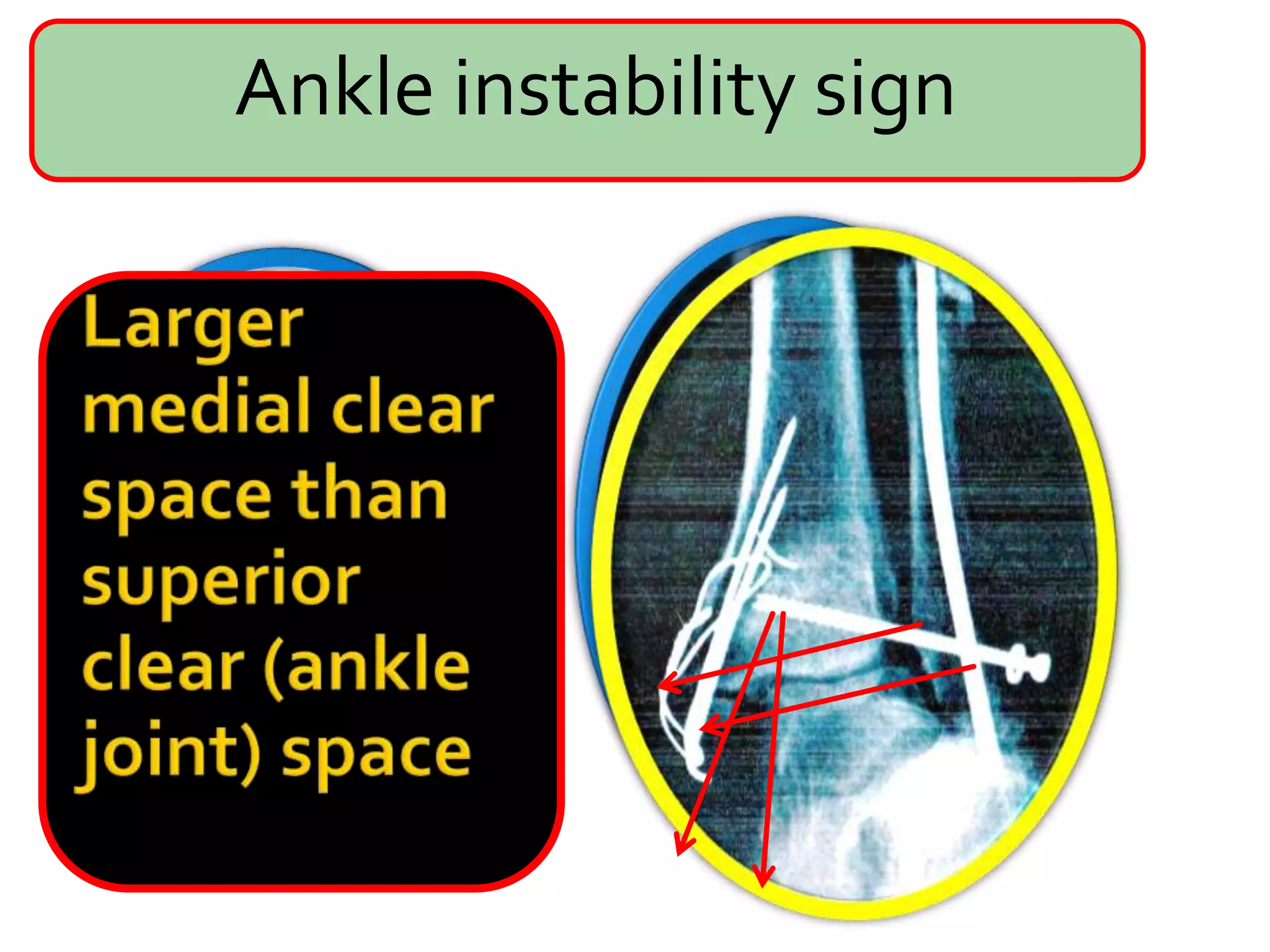 Lecture 3 shah radiology in foot and ankle | PPTX
