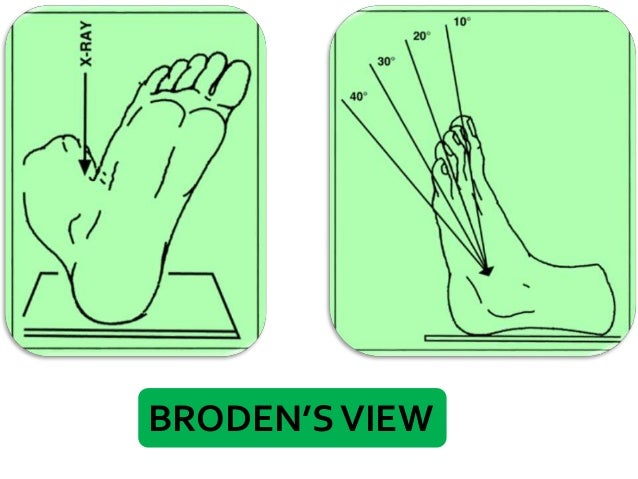 Lecture 3 shah radiology in foot and ankle