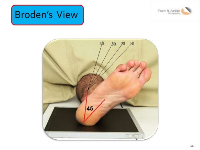Lecture 3 shah radiology in foot and ankle