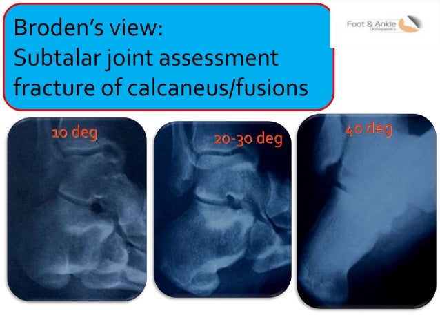 Lecture 3 shah radiology in foot and ankle