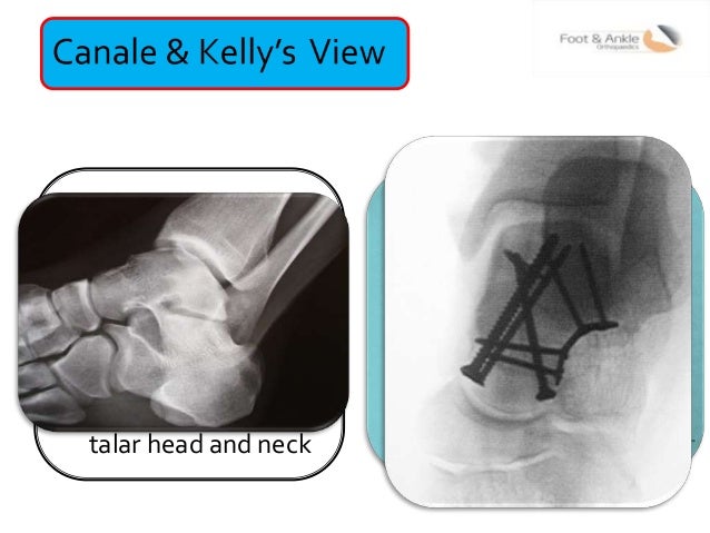 Lecture 3 shah radiology in foot and ankle