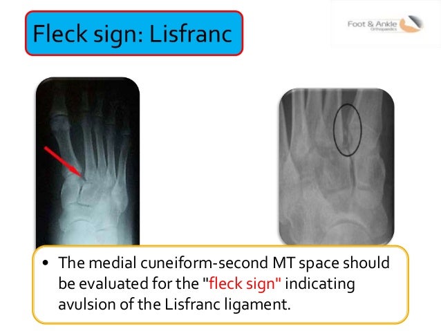 Lecture 3 shah radiology in foot and ankle