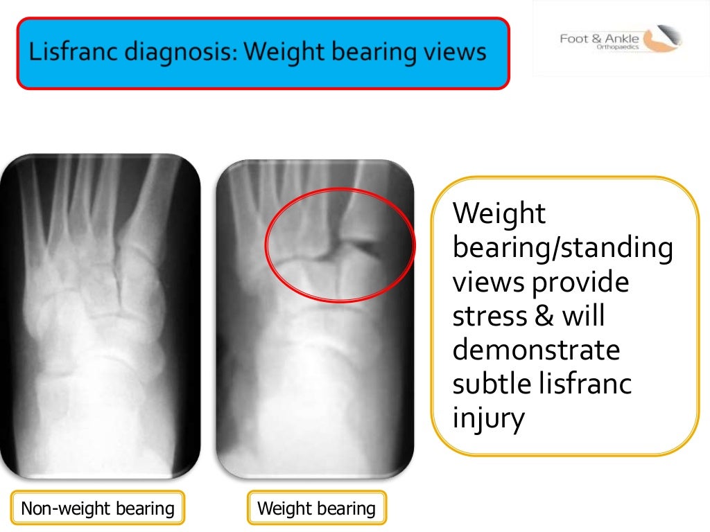 Lecture 3 shah radiology in foot and ankle