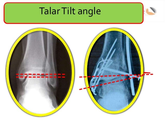 Lecture 3 shah radiology in foot and ankle