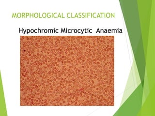 Lecture 4. classification of anemia | PPTX