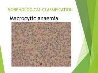 Lecture 4. classification of anemia | PPTX