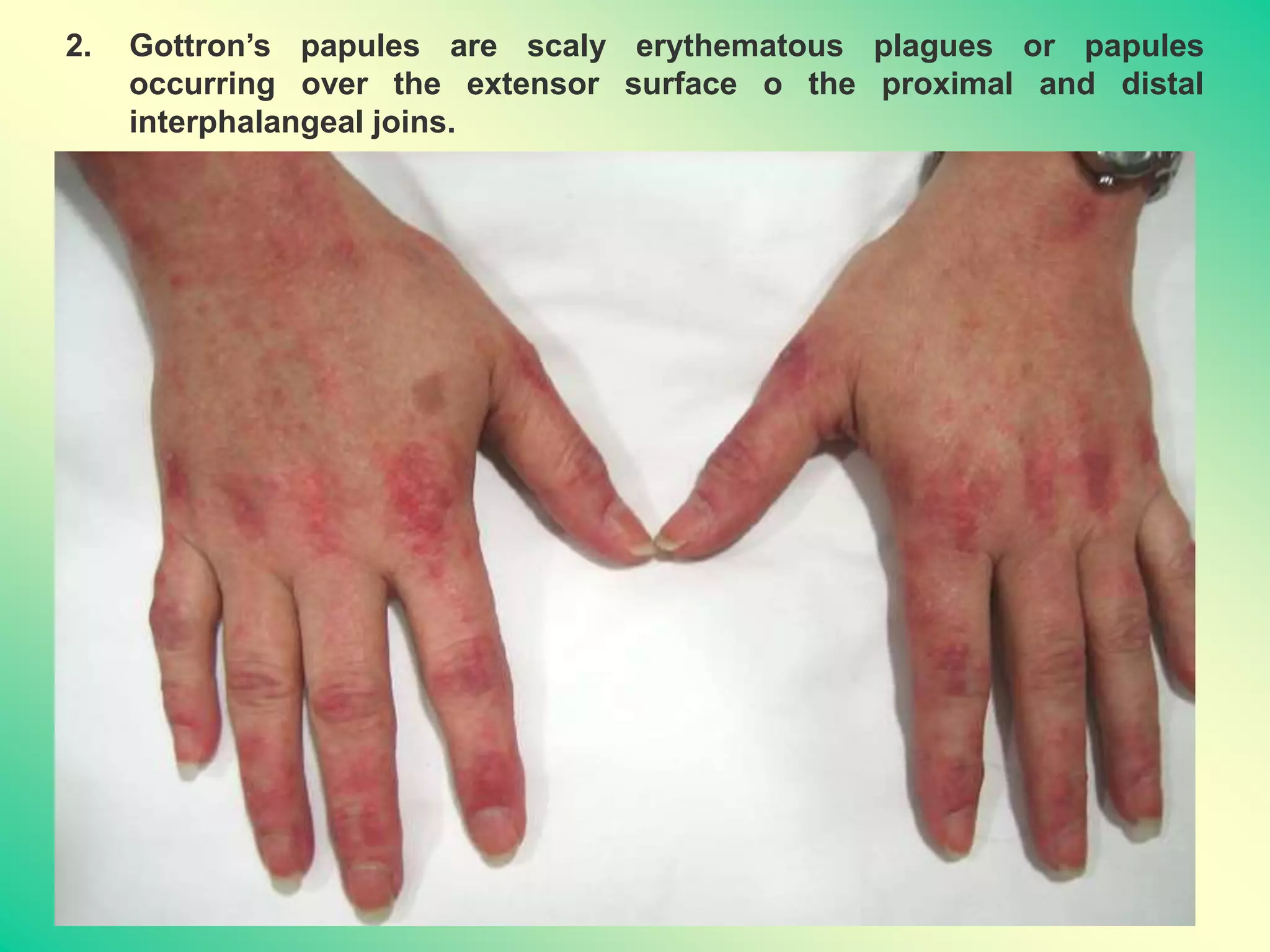 Systemic Connective Tissue Inflammatory Syndrome Lecture 4 | PPT