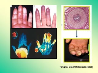 Systemic Connective Tissue Inflammatory Syndrome Lecture 4 | PPT