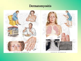 Systemic Connective Tissue Inflammatory Syndrome Lecture 4 | PPT
