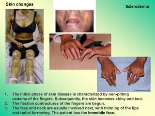 Systemic Connective Tissue Inflammatory Syndrome Lecture 4 | PPT