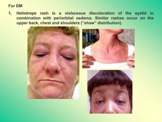 Systemic Connective Tissue Inflammatory Syndrome Lecture 4 | PPT