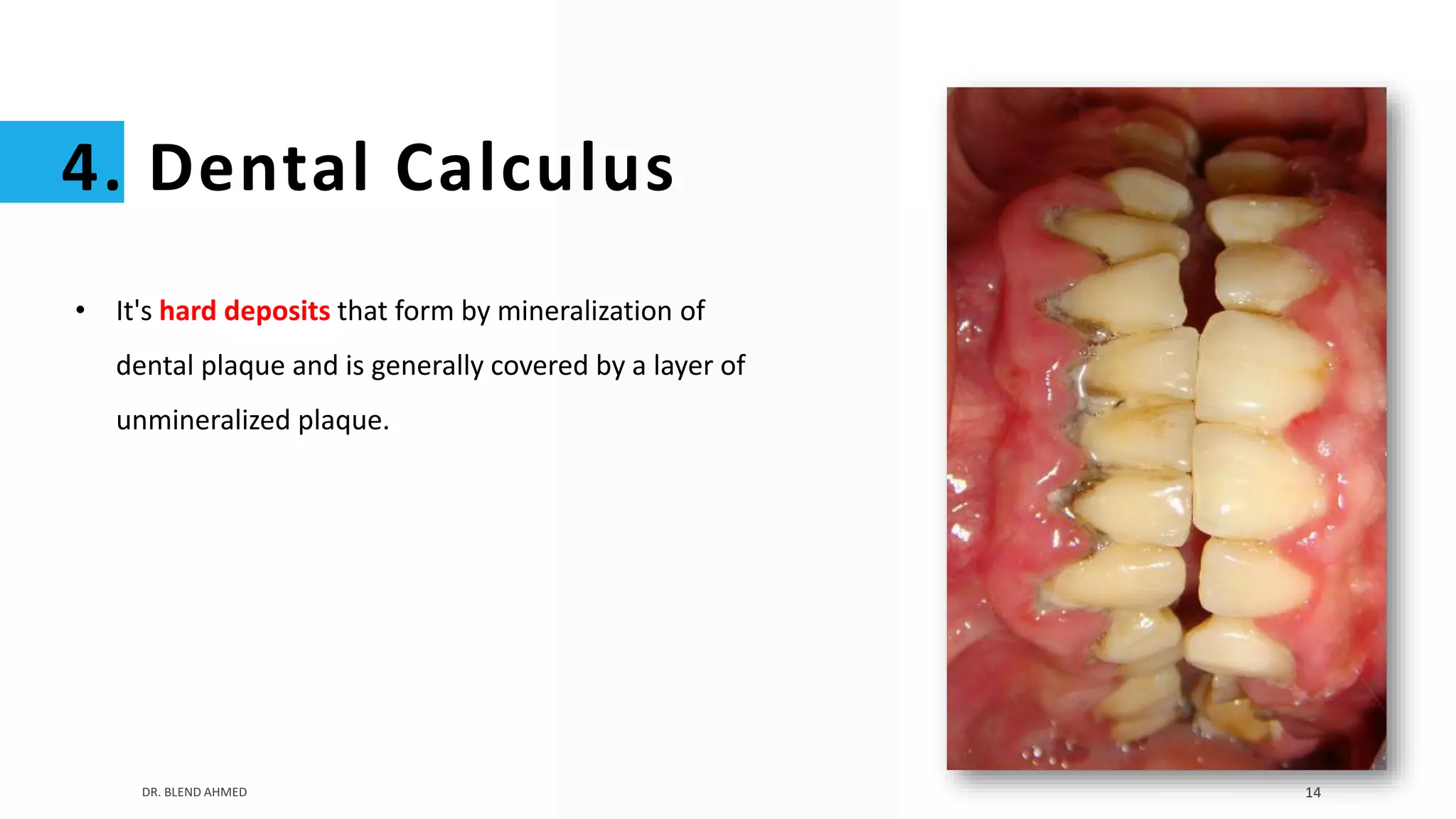 Deposits on the Teeth | PDF
