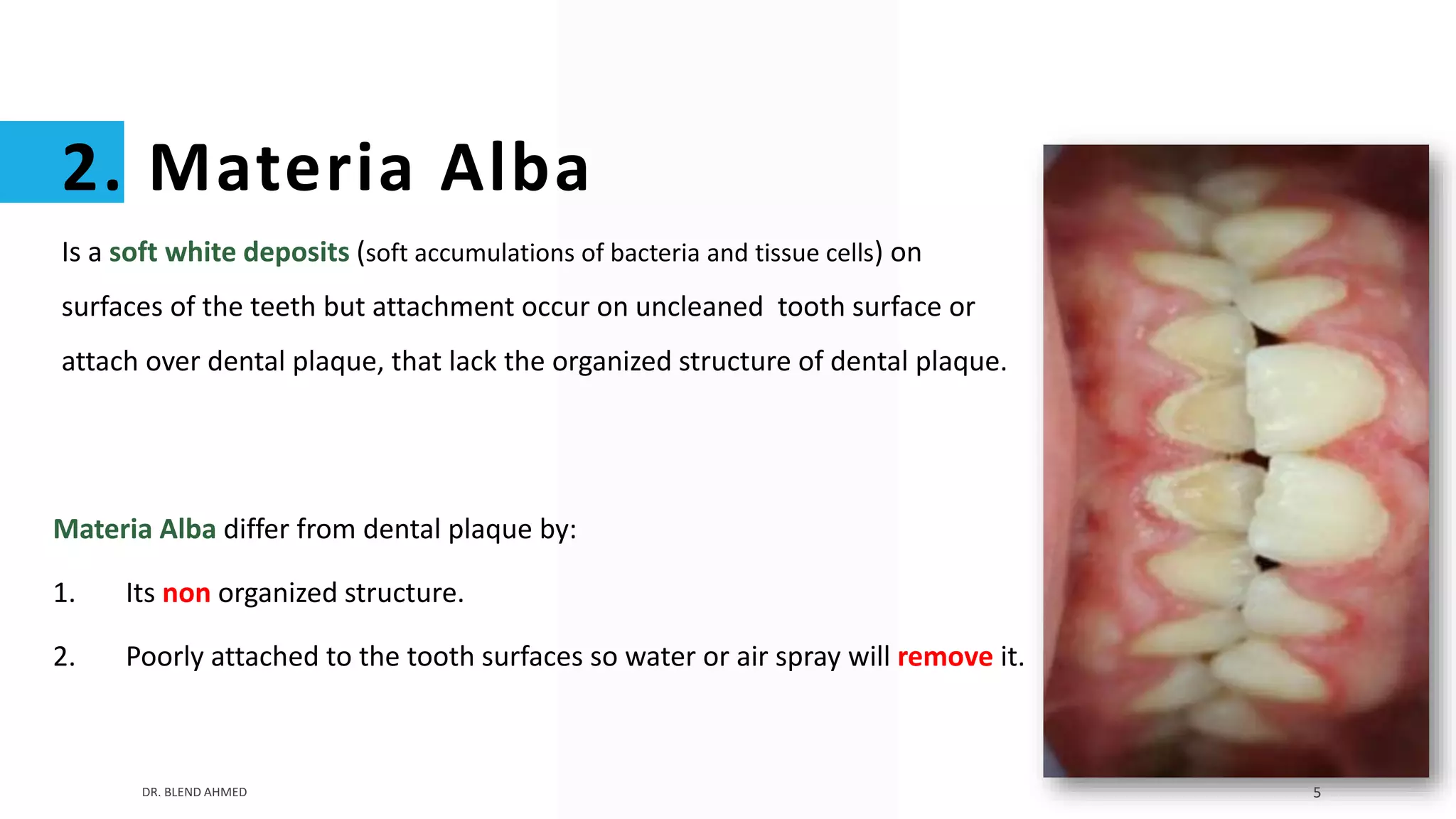 Deposits on the Teeth | PDF