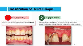Deposits on the Teeth | PDF