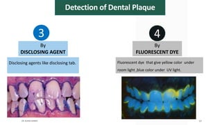 Deposits on the Teeth | PDF