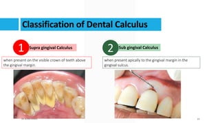 Deposits on the Teeth | PDF