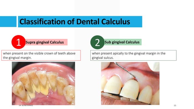 Deposits on the Teeth | PDF | Dental Health | Diseases and Conditions