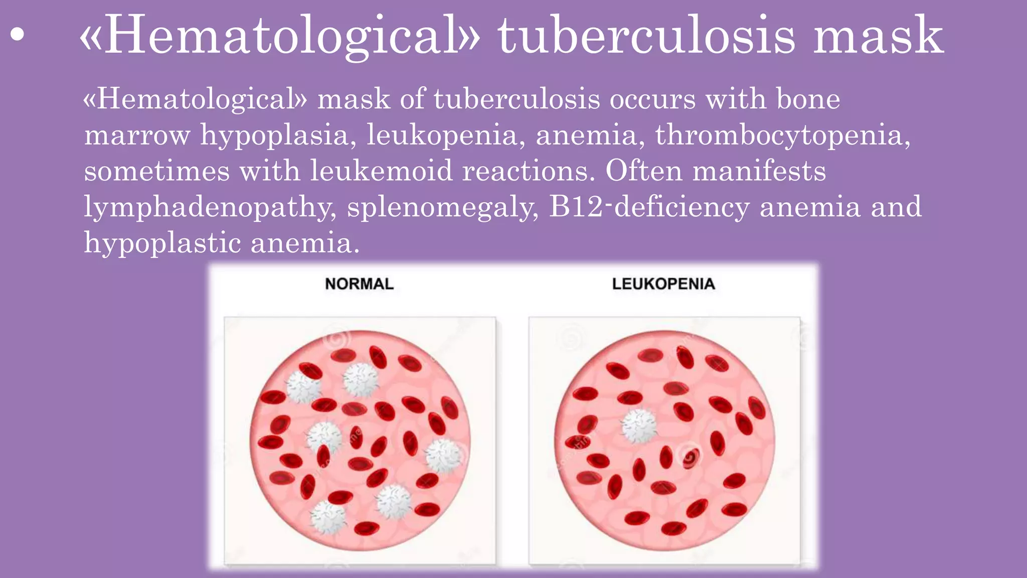 Primary and secondary forms of tuberculosis | PPTX