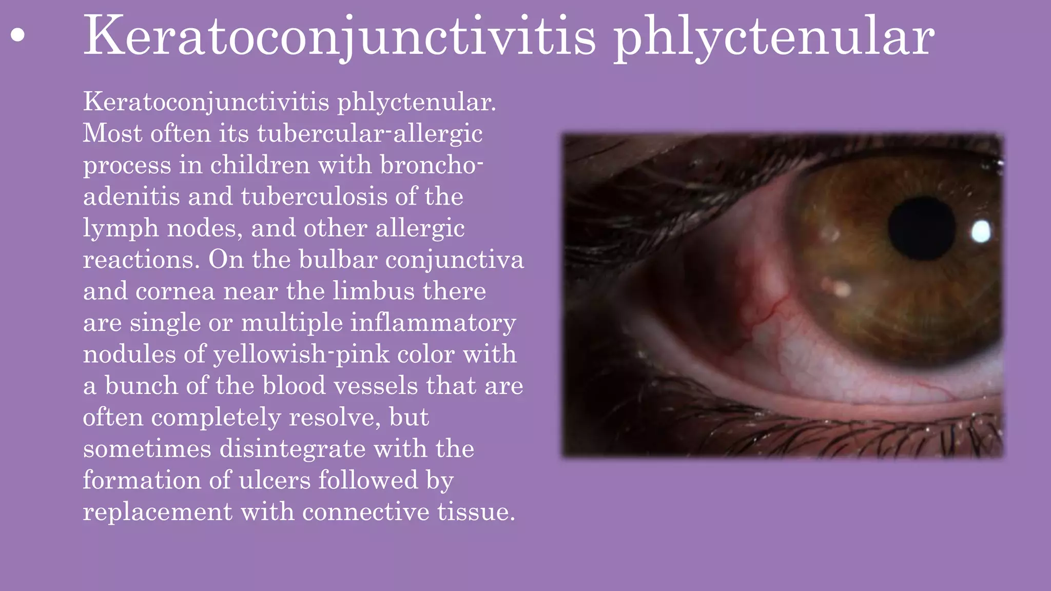 Primary and secondary forms of tuberculosis | PPTX