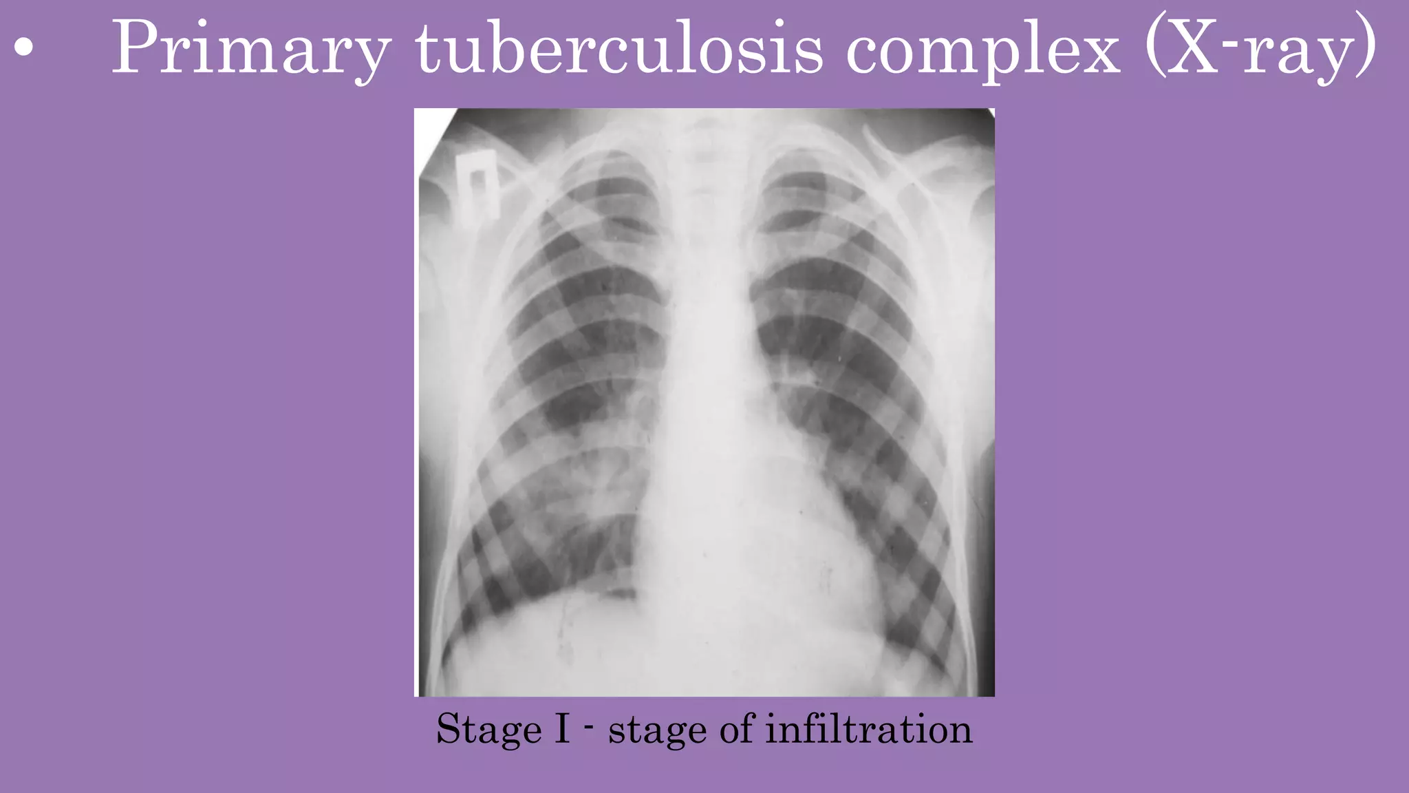 Primary and secondary forms of tuberculosis | PPTX