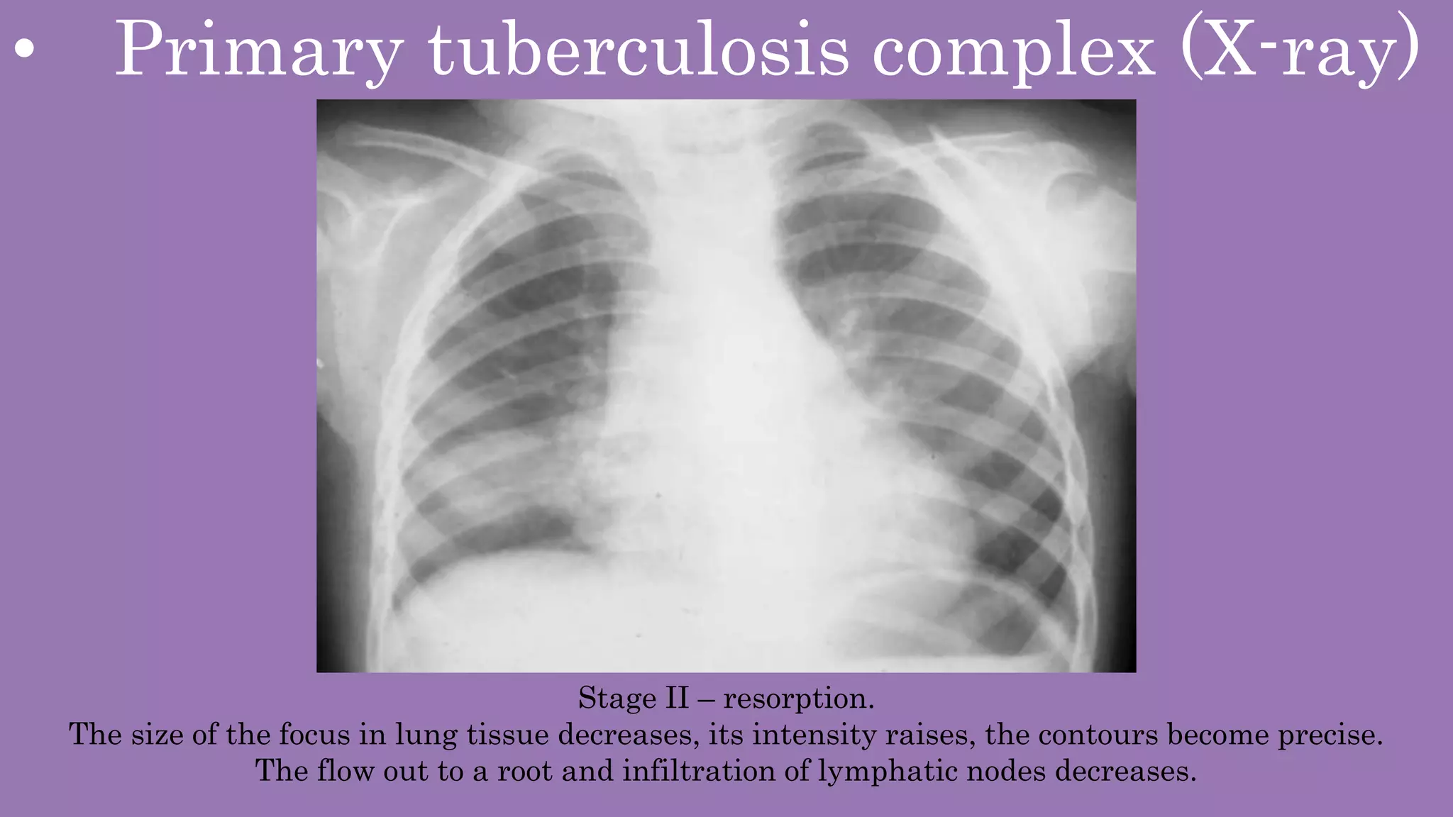 Primary and secondary forms of tuberculosis | PPTX