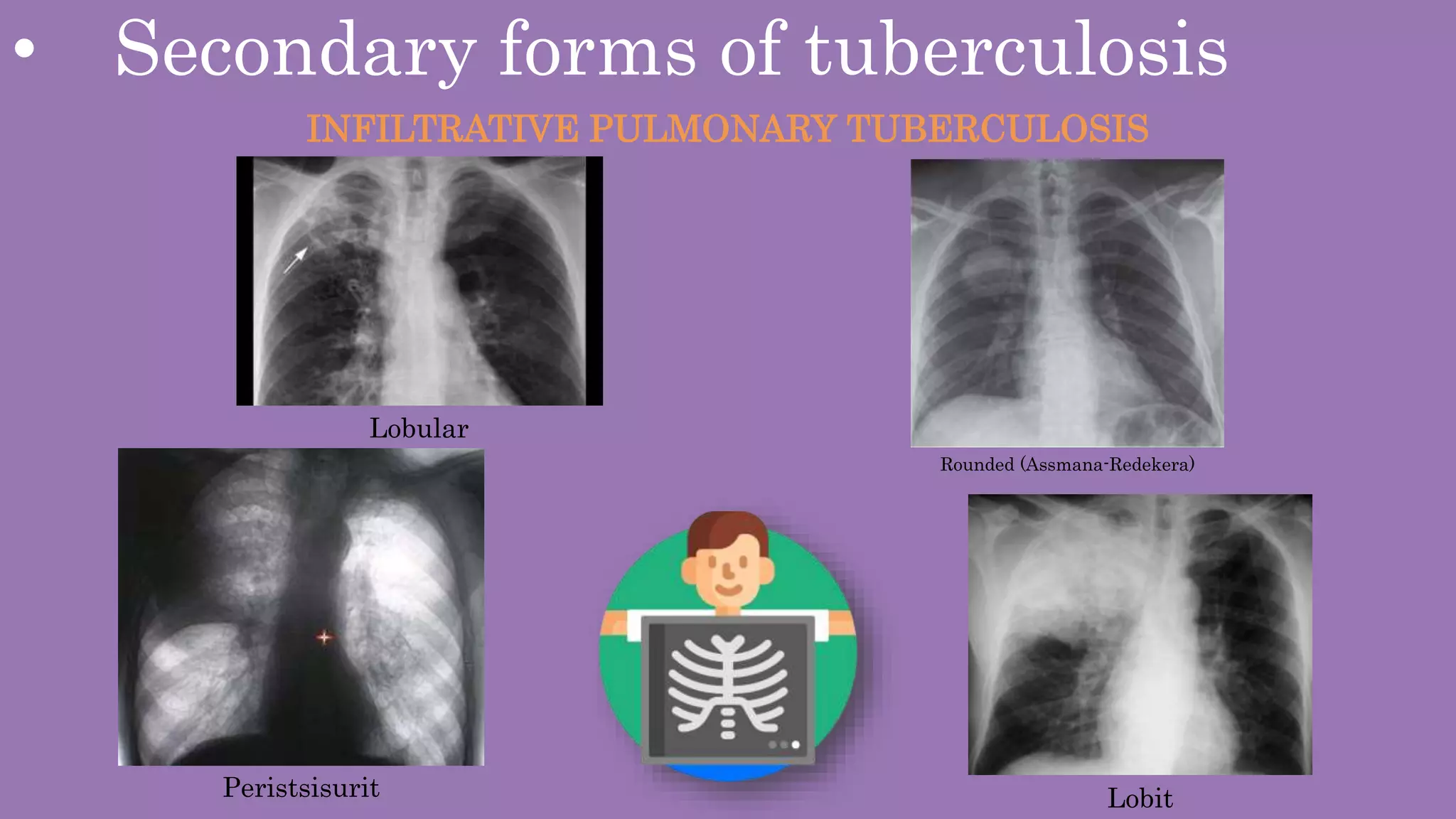 Primary and secondary forms of tuberculosis | PPTX | Blood Disorders ...