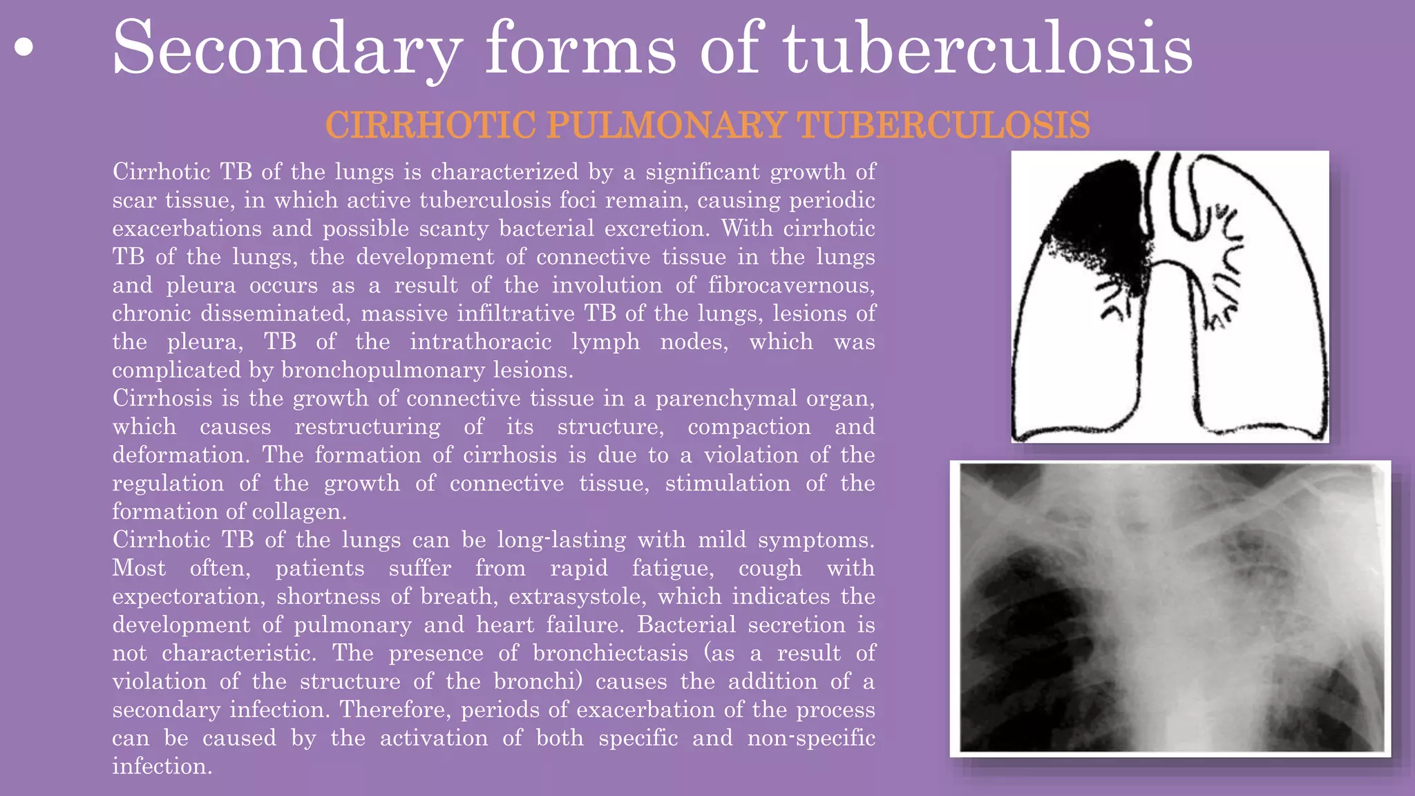Primary and secondary forms of tuberculosis | PPTX