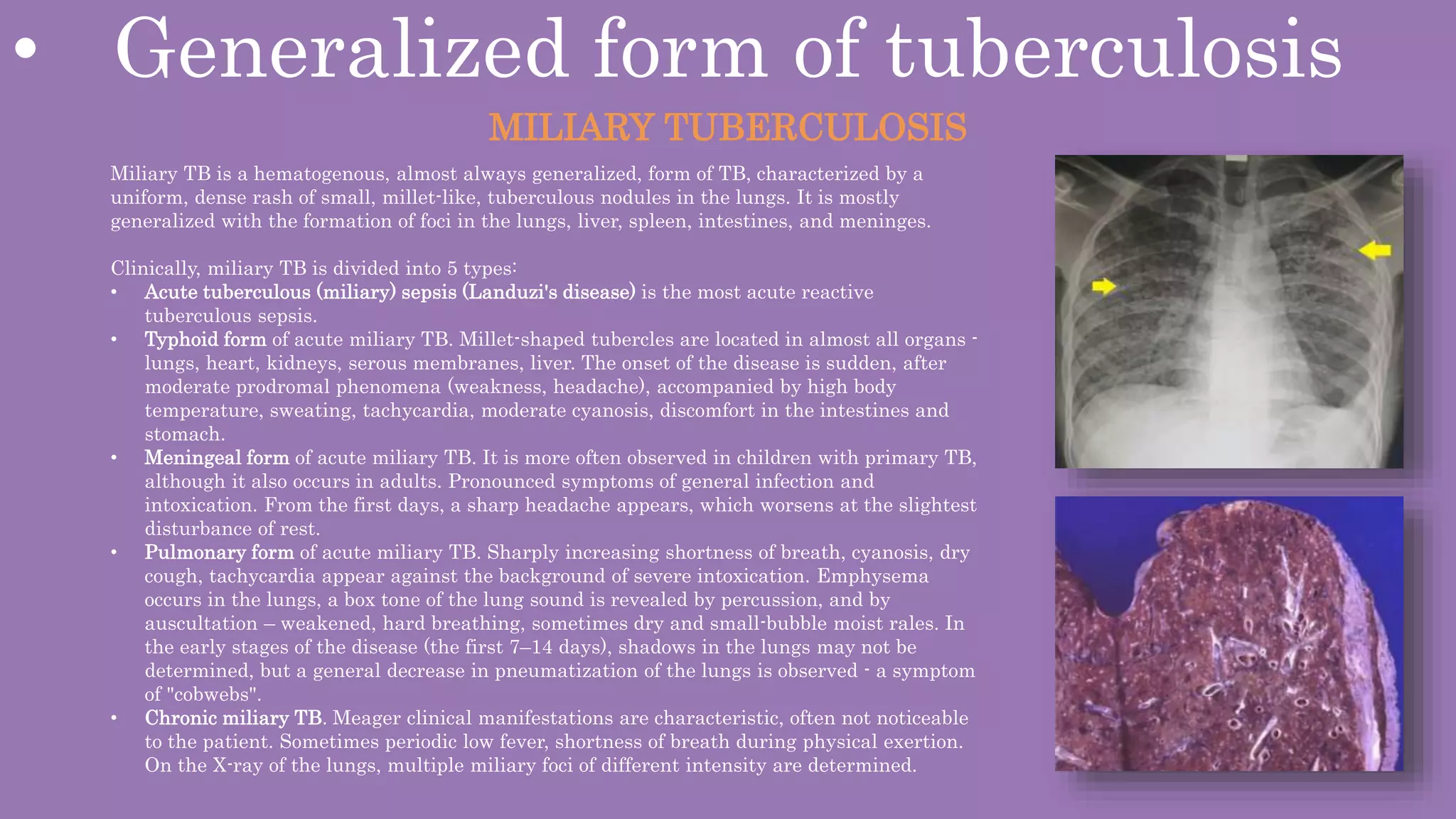 Primary and secondary forms of tuberculosis | PPTX