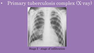 Primary and secondary forms of tuberculosis | PPTX
