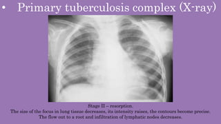 Primary and secondary forms of tuberculosis | PPTX