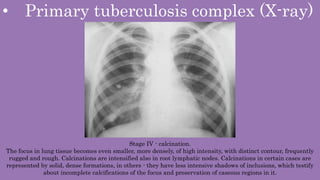 Primary and secondary forms of tuberculosis | PPTX
