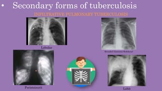 Primary and secondary forms of tuberculosis | PPTX | Blood Disorders ...